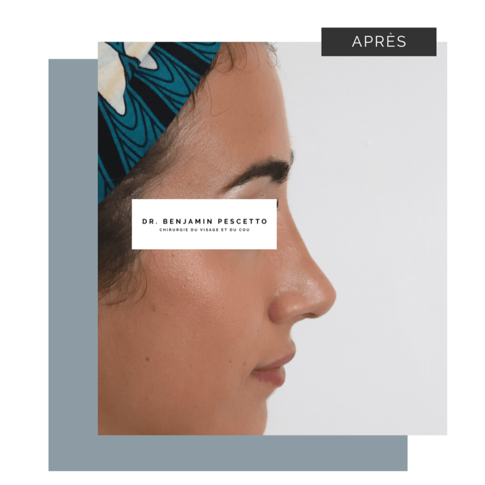 Rhinoplastie - Docteur Benjamin Pescetto